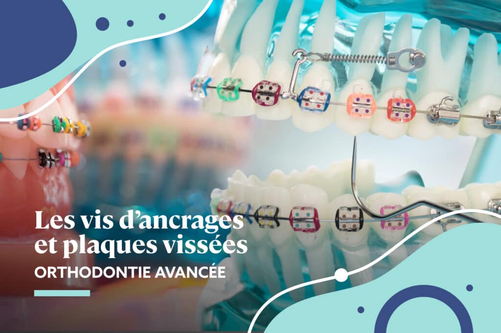 Vis d'ancrage et plaques vissées en orthodontie | ESO